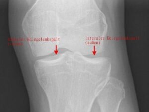 Meniskus Symptome: Wie fühlt sich ein Riss im Meniskus an? | Knie-OP & Reha