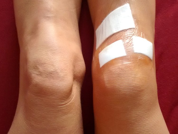 Nach Kreuzband-OP - 5 falsche Erwartungen (2) | Knie-OP & Reha Nach Kreuzband-OP - 5 falsche Erwartungen (2) | Knie-OP & Reha
