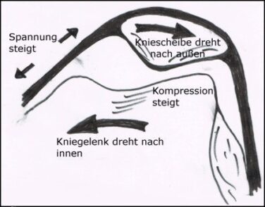 Instabile Kniescheibe mit schweren Folgen - 31 Operationen am Knie ...