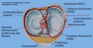 Diagnose Meniskusriss: Blick auf Verletzungsgrad 1,2 und 3,4 | Knie-OP ...